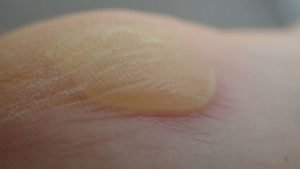 How to Treat Blisters - Lotsafreshair